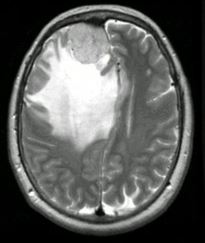 Brain Tumor Detection Object Detection Model by Brain Tumor