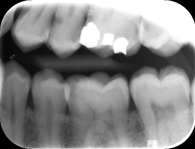 PE-OC-BWcaries merged Instance Segmentation Dataset by Dental Xray ...