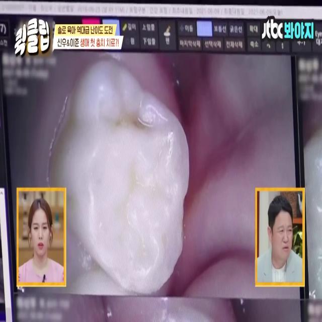 cavity Object Detection Model by manuelworkspace