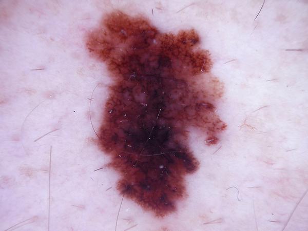 Melanoma Detection 2 Instance Segmentation Dataset By Segmentation