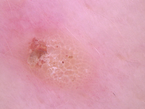 Skin Cancer Object Detection Object Detection Dataset By Lp