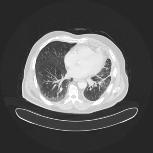 Lung Nodule Detection Object Detection Dataset And Pre Trained Model By College