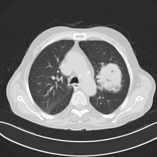 Lung Nodule Object Detection Dataset And Pre Trained Model By College