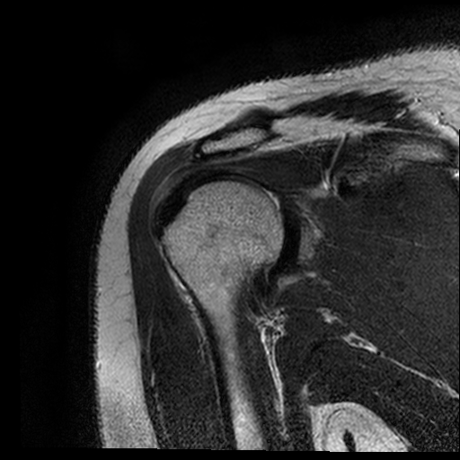 ShoulderMRI Classification Model by shoulderMRI