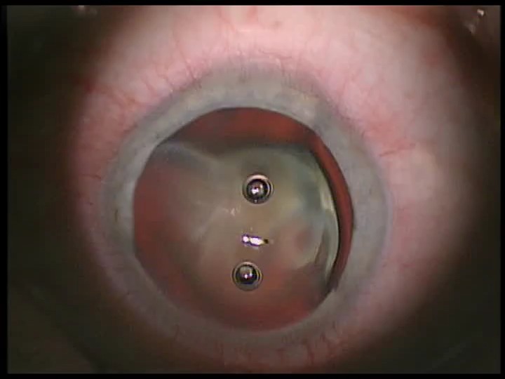 cataract Instance Segmentation Model by test