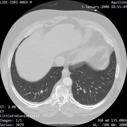 Lung Nodule Object Detection Dataset and Pre-Trained Model by jaundice