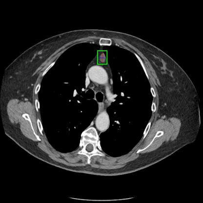 Lung Tumor Instance Segmentation Dataset and Pre-Trained Model by Lung and Pancreatic Tumor ...