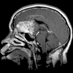 beyin_tumor Object Detection Model by Atatrk niversitesi