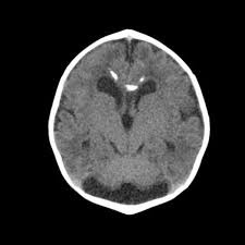 Labeled MRI Brain Tumor Dataset Object Detection Model by Ali Rostami