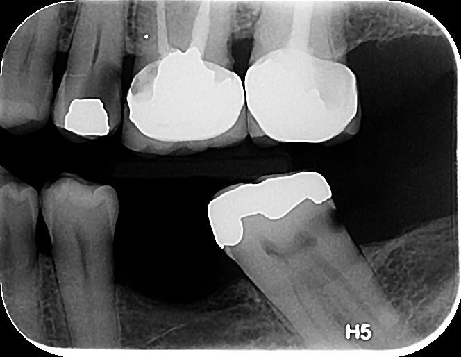 bitewing radiographs Classification Dataset by ali