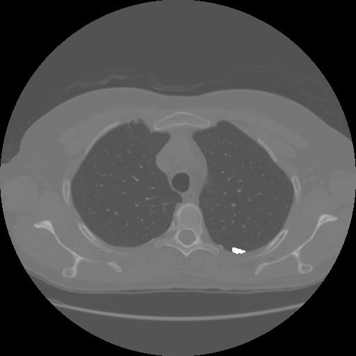 Lung Cancer Nodule 2 Object Detection Dataset By School