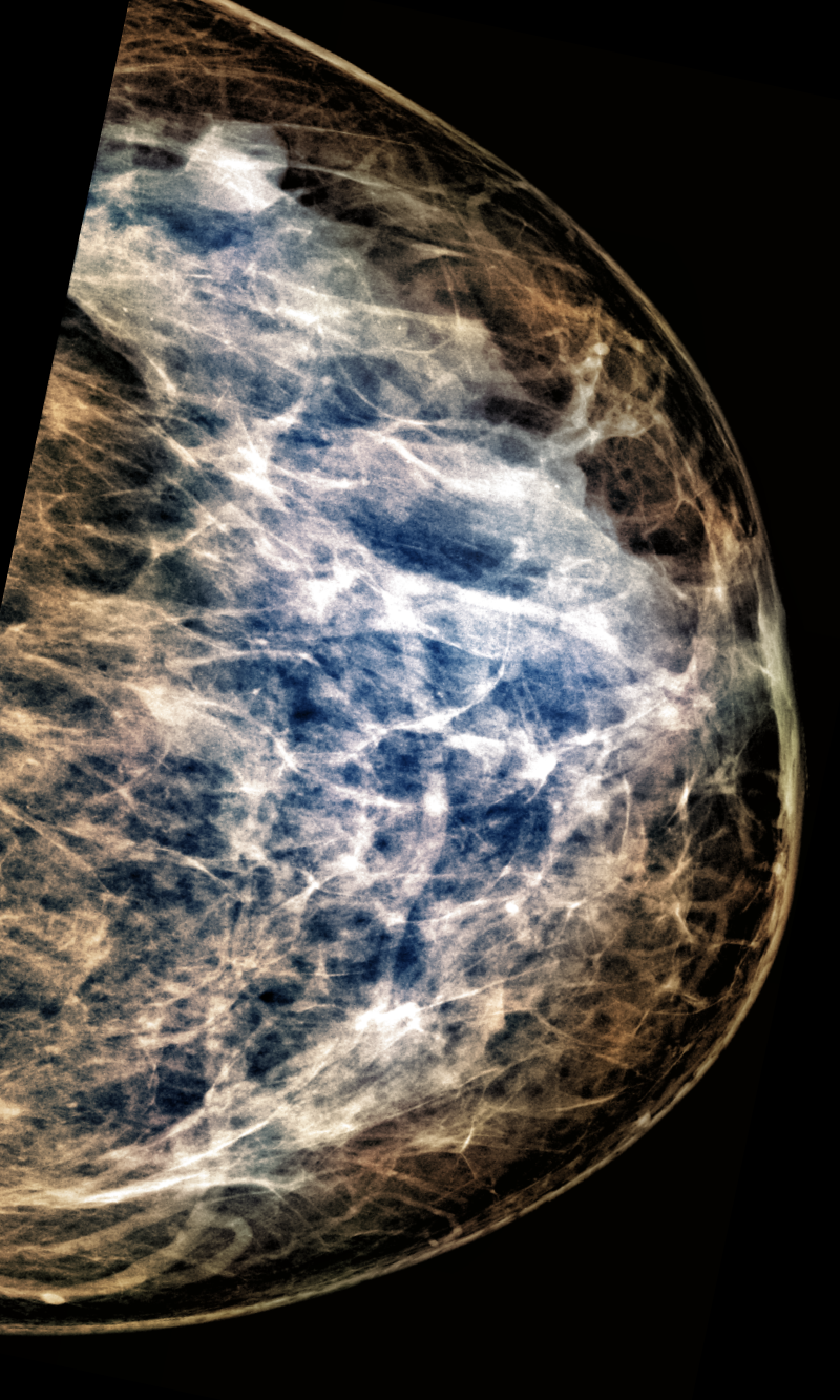 INBreast Object Detection Model (v2, Without_Augmentation) by Akshay Krishna