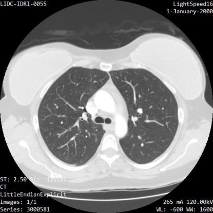 Lung cancer detection Instance Segmentation Dataset by Indoordataset