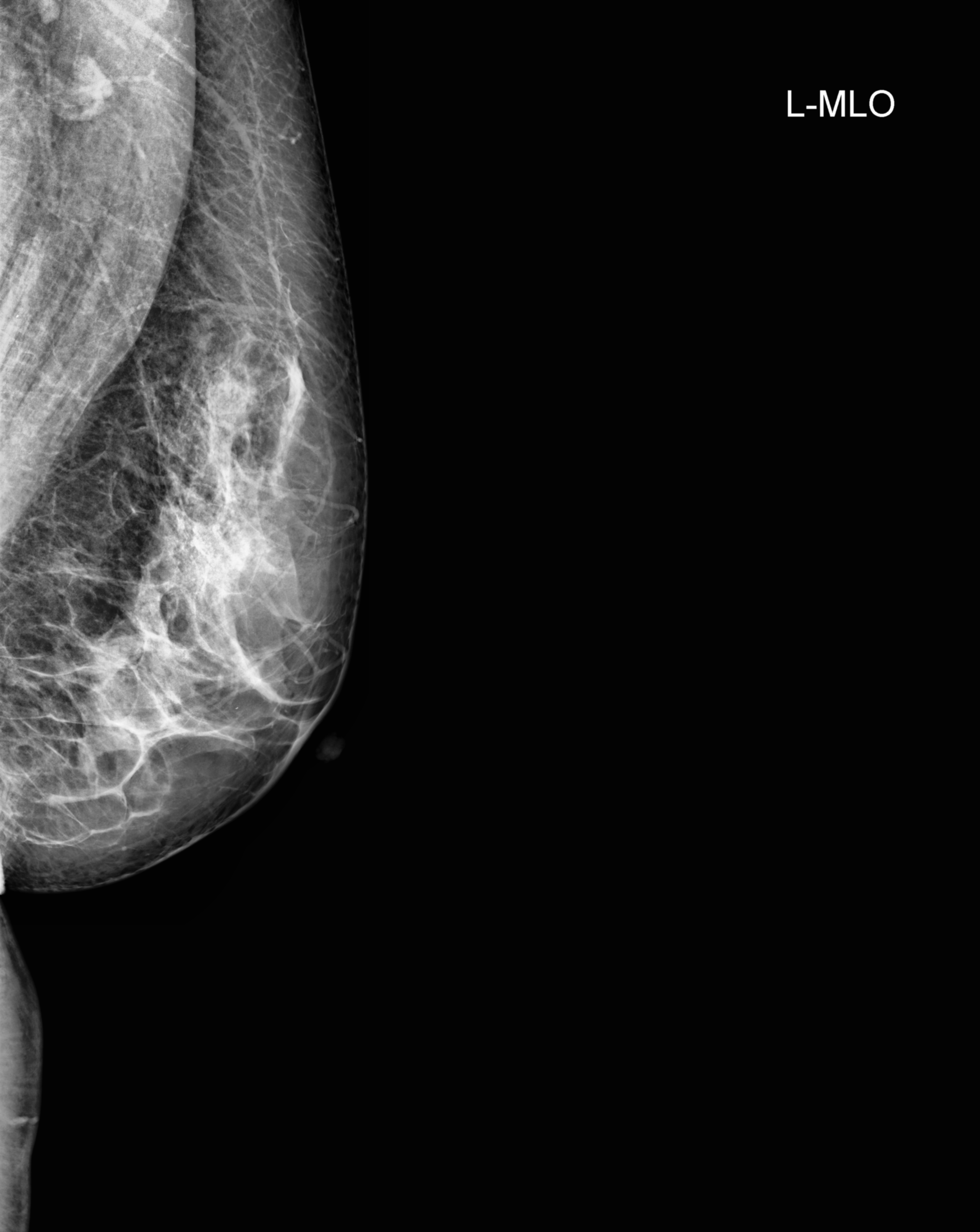 Breast Suspicious Calcification Object Detection Dataset By Cancer