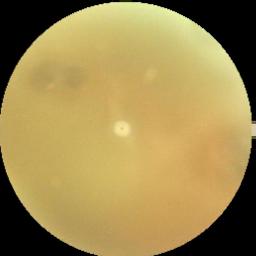 cataract Object Detection Dataset by Eye Diseases prediction