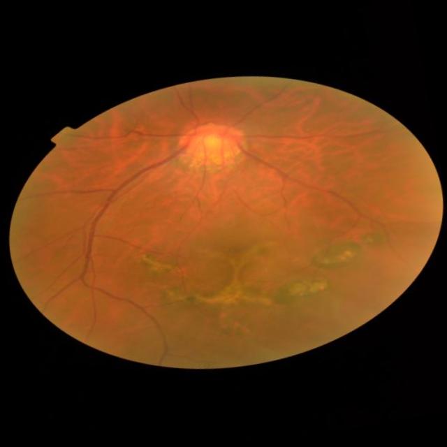 Retina Disease Object Detection Dataset By Eye Diseases Prediction
