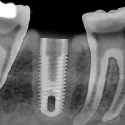 Teeth Segmentation ToothFairy Instance Segmentation Model by Internship