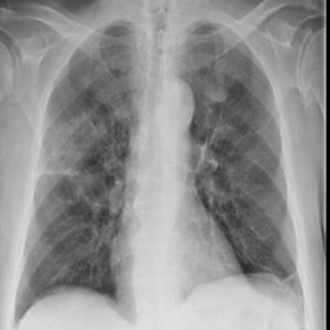Lung Segmentation Object Detection Dataset by Lung Segmentation