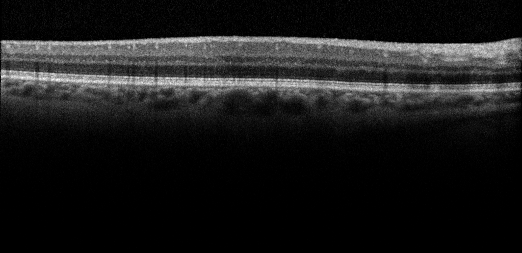OCT Segmentation - Roboflow Universe