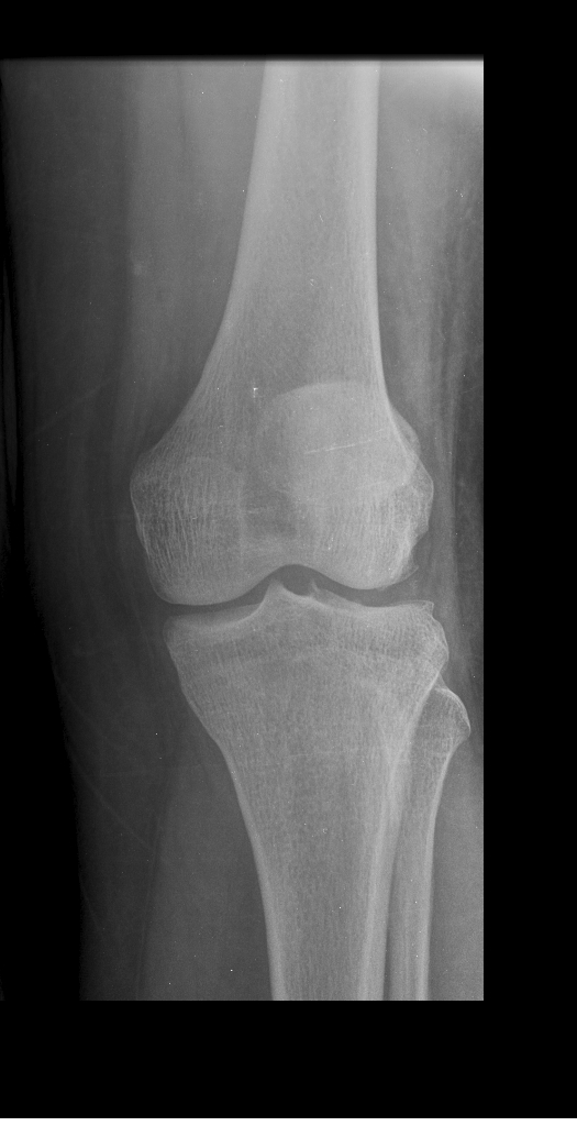 Osteoporosis 2 Classification Dataset by IRC