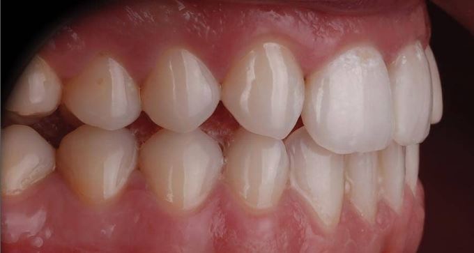 Tooth Labelling Object Detection Model by Teeth Images