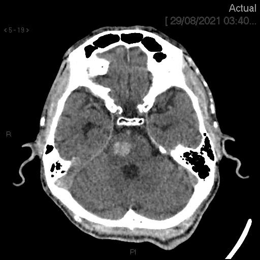 CT Brain Segmentation Instance Segmentation Dataset and Pre-Trained Model by Solvent