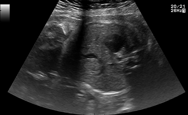 fetal_abdomen_circumference Semantic Segmentation Model by yolo