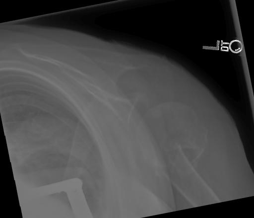 Bone Fracture Detection Object Detection Dataset And Pre Trained Model