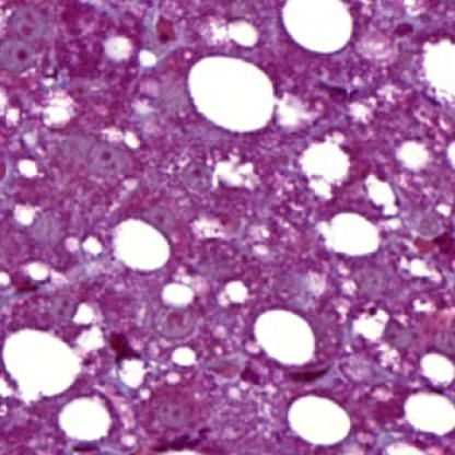 liver-diseases-gjyx Object Detection Dataset by Roboflow100VL Full