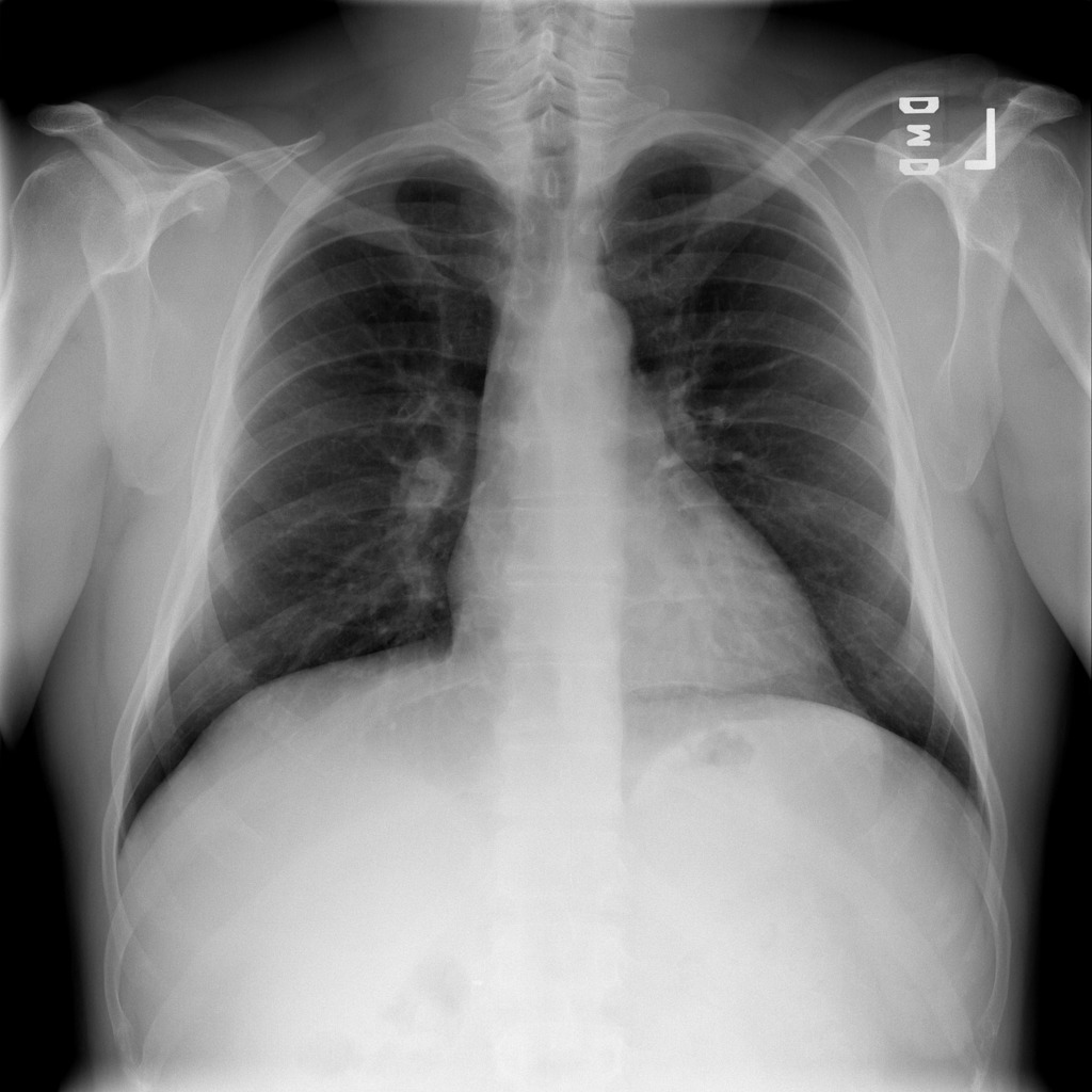 Rsna Pneumonia Detection Dataset Object Detection Dataset V1 Rsna