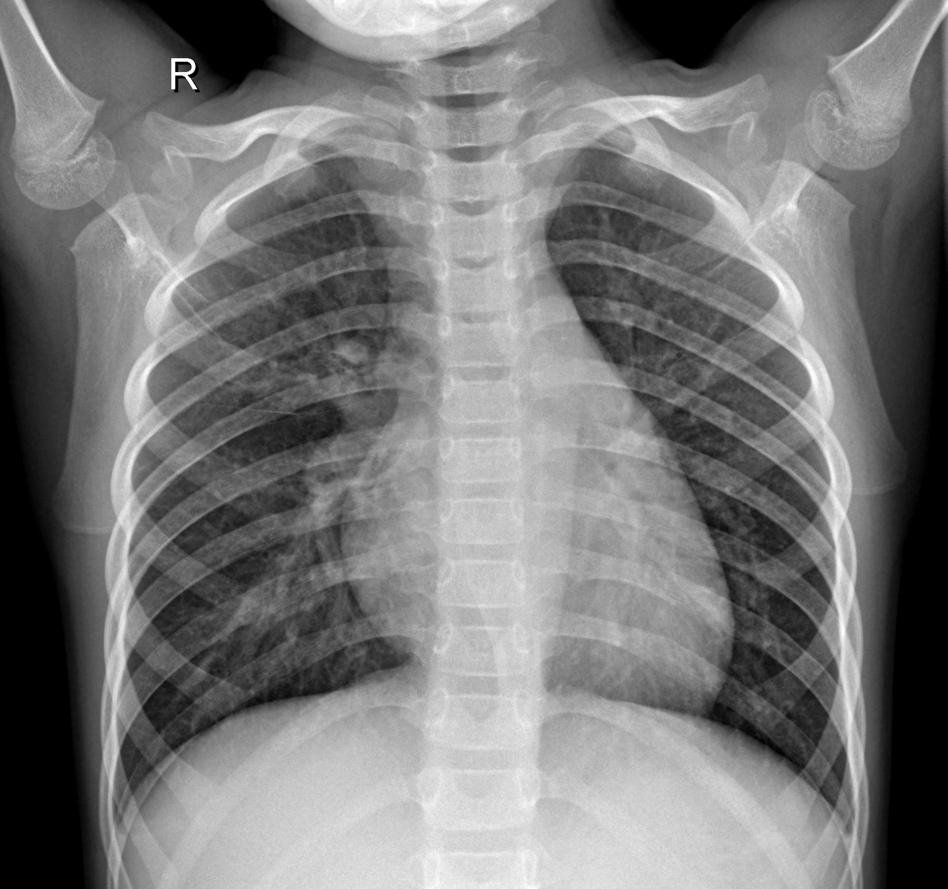 COVID-19 Chest X-ray Object Detection Dataset and Pre-Trained Model by YT