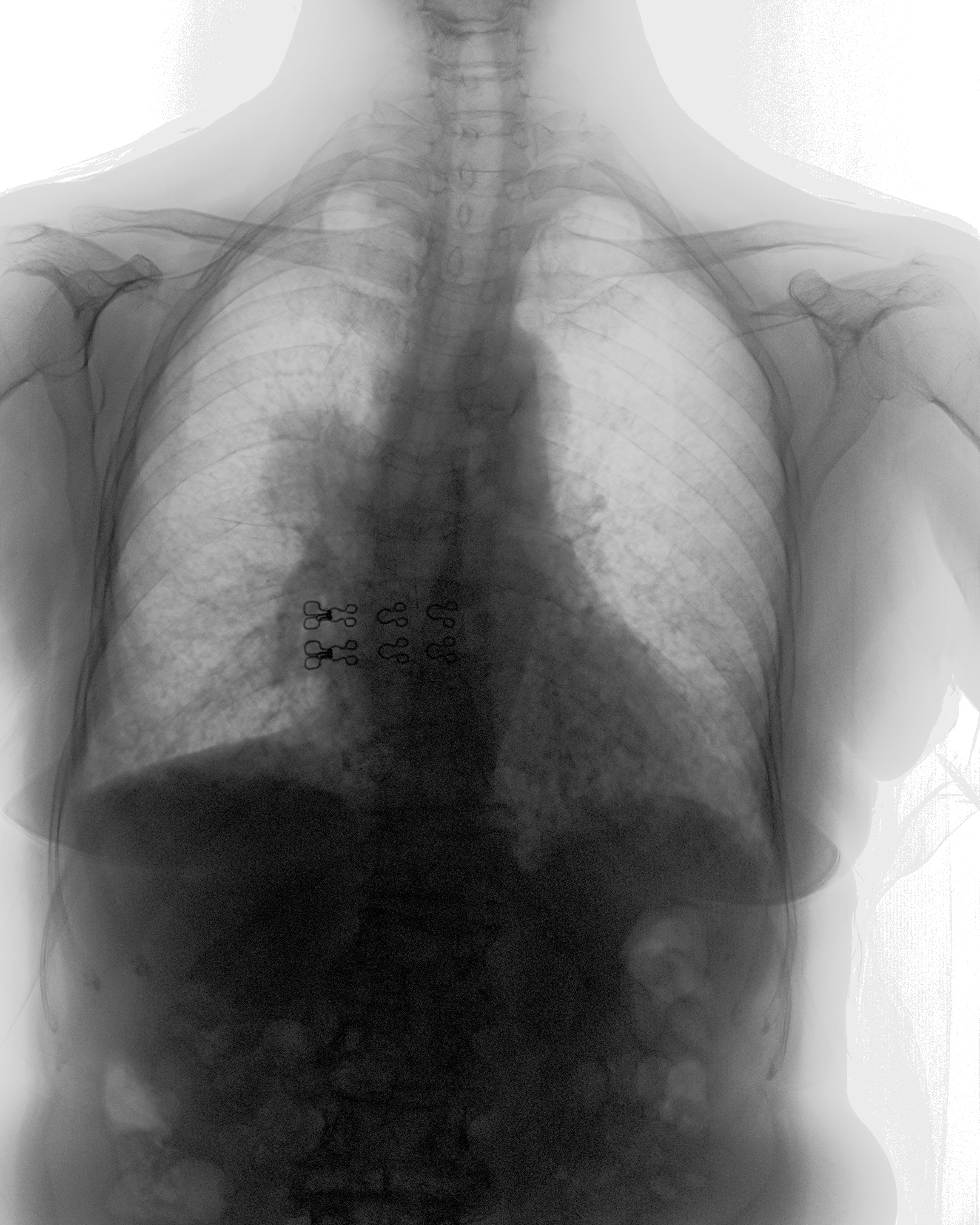 Chest Xray Object Detection Dataset by trung