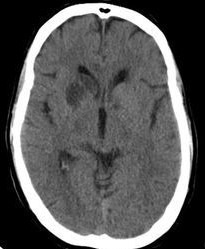Brain Tumor Detection Object Detection Dataset by ISR1