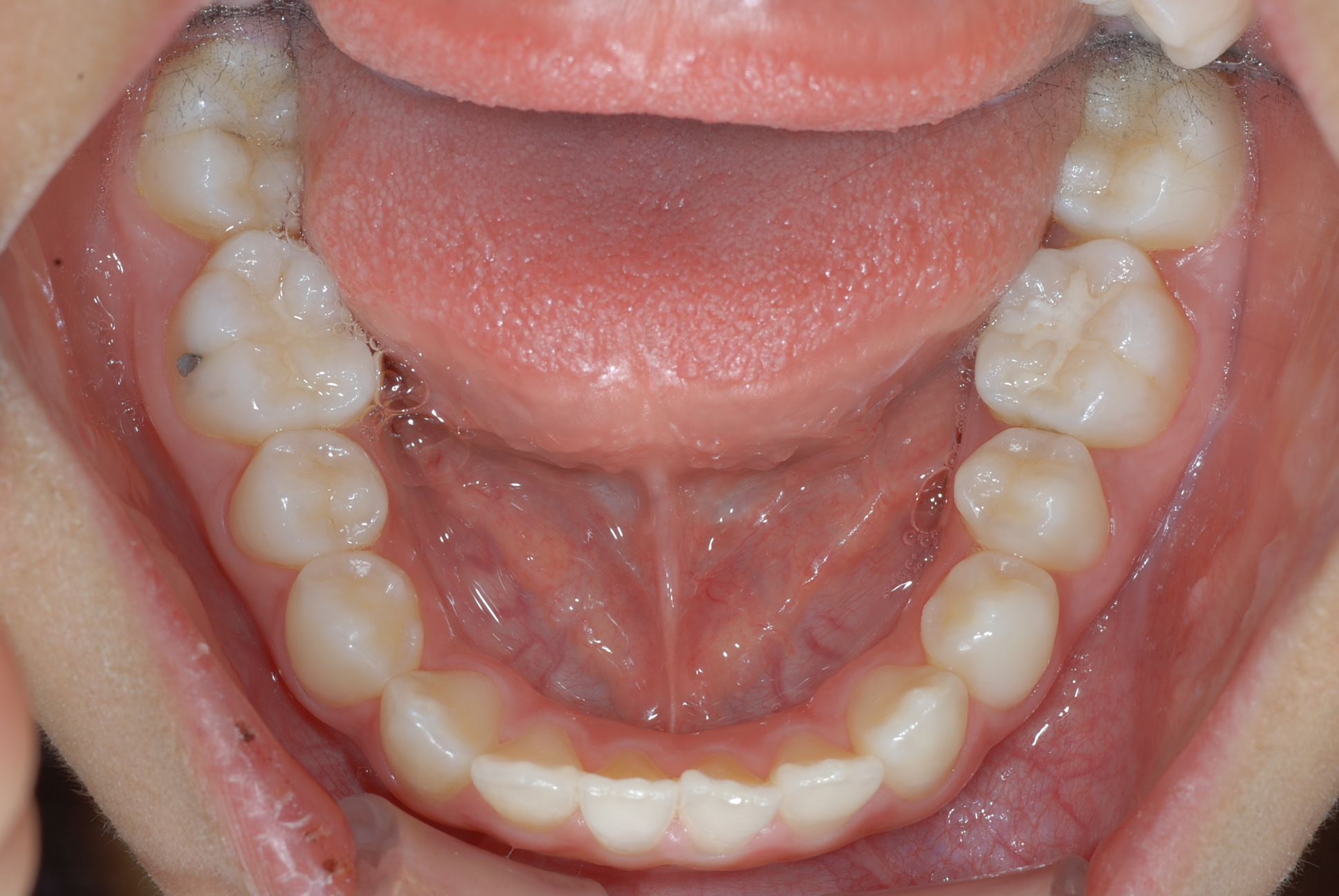 tooth_4200to5500 Object Detection Dataset by Dection