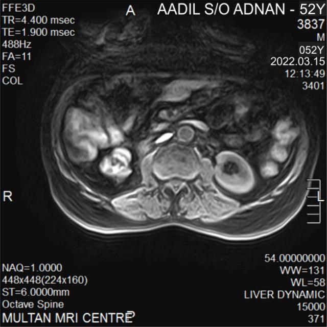 Liver Tumor Object Detection Dataset by Alisha