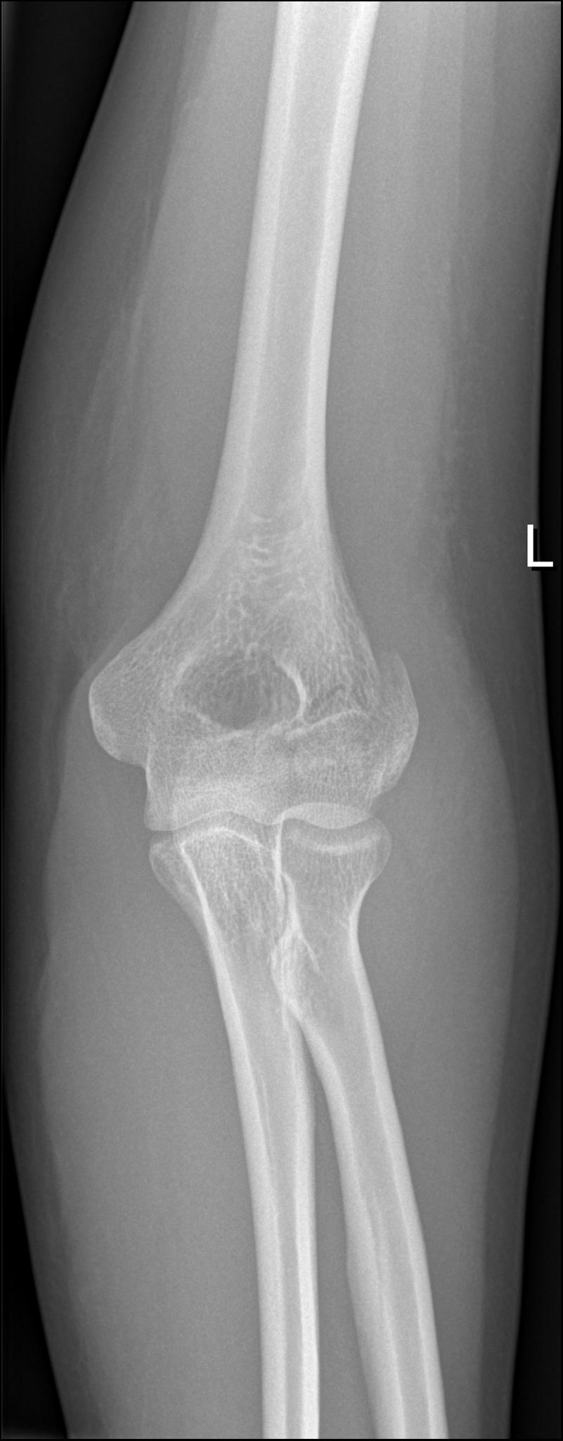 Bone Fracture Detection Object Detection Dataset By Bone Fracture Detection