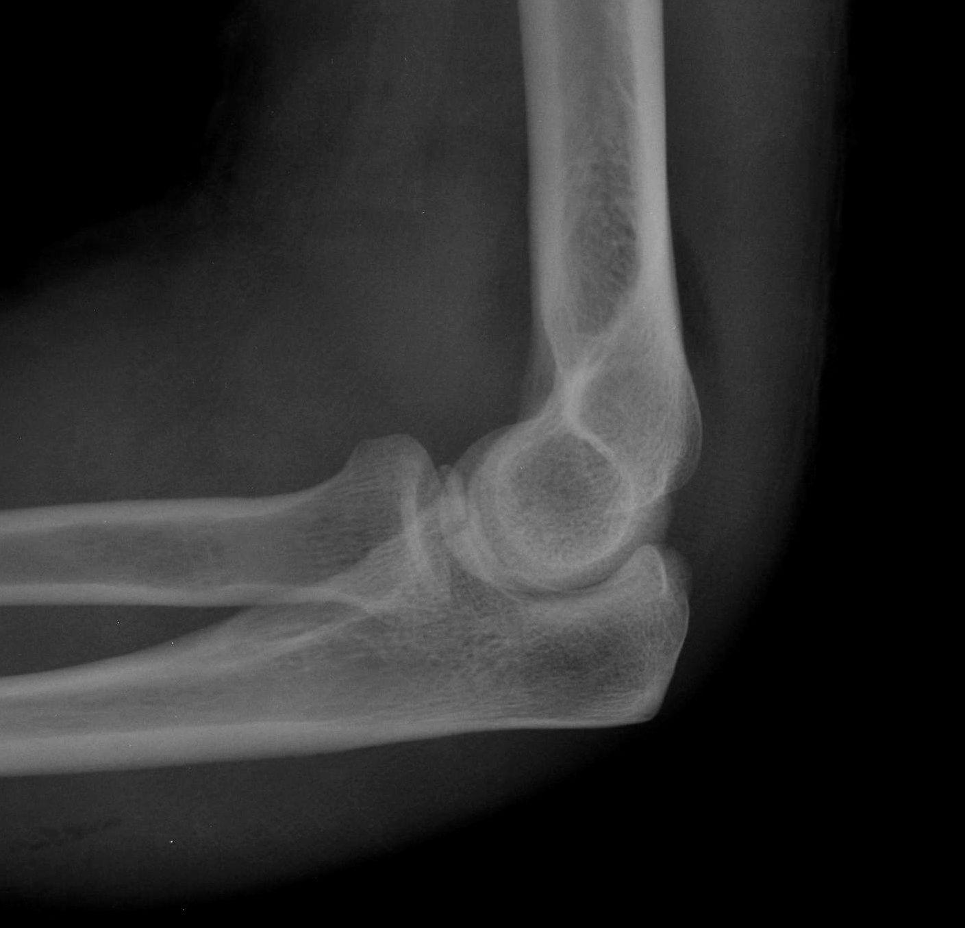 Bone Fracture Detection Object Detection Dataset By Bonefracture