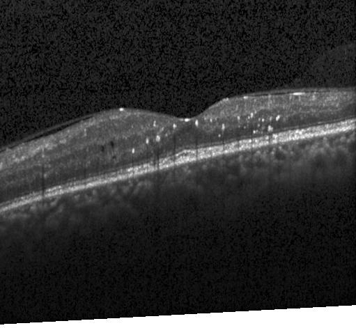 DME hyper dots Object Detection Model by Randa