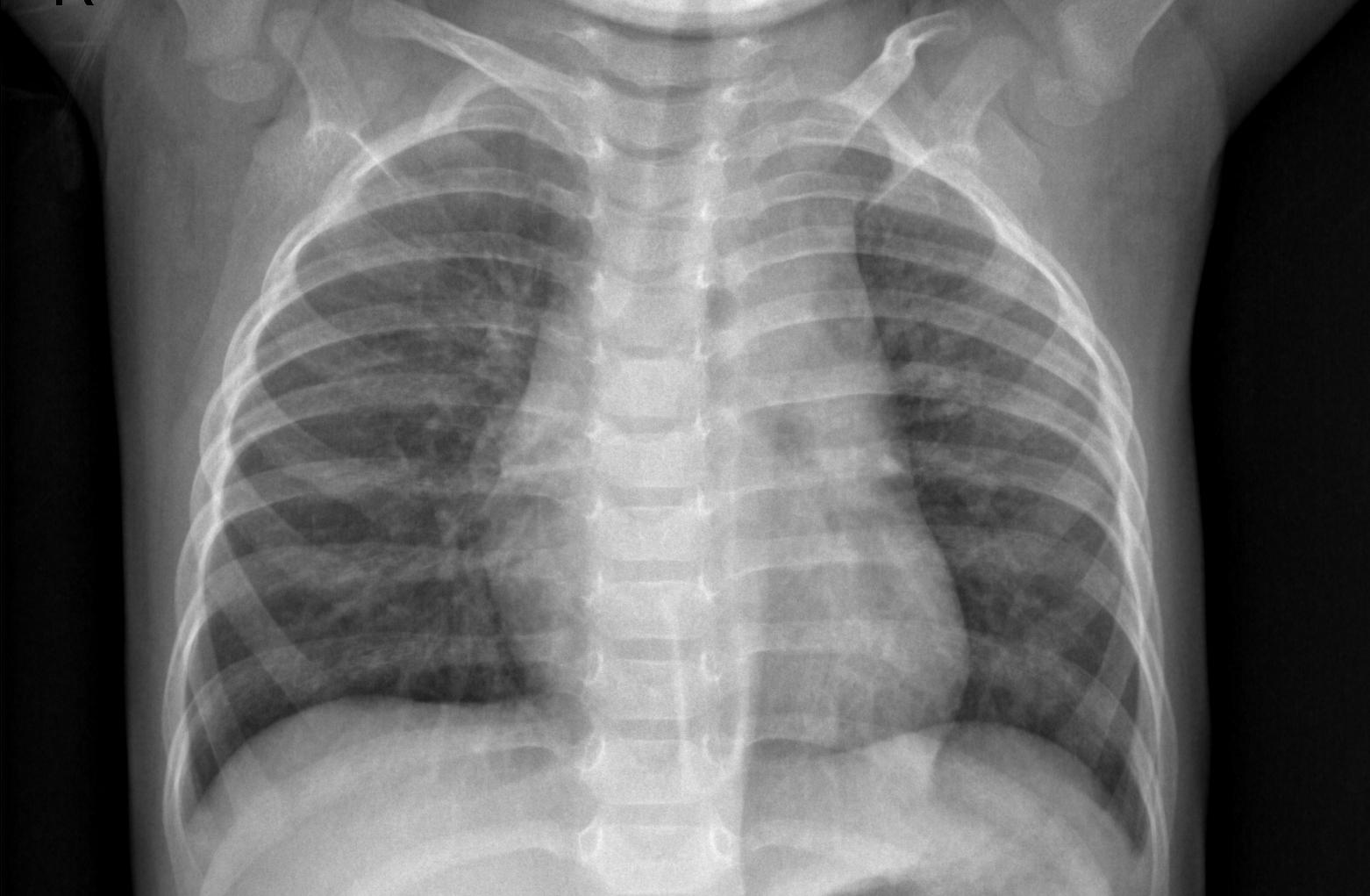 RX de torax Object Detection Dataset and Pre-Trained Model by Torax PDI