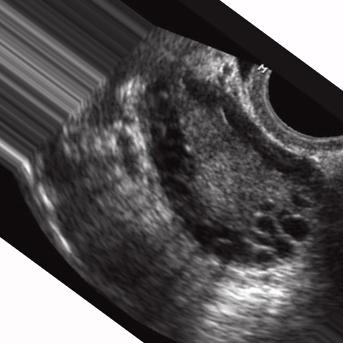 PCOS detection Object Detection Model by PCOS data annotation