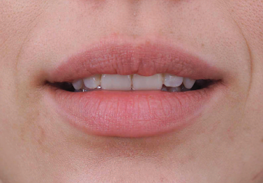 LIP SHAPE DETETCTION Instance Segmentation Model by Georgia Benitha