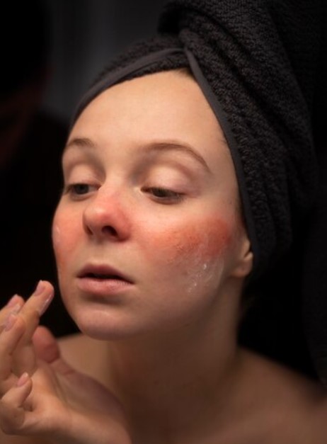 Face disease detection Instance Segmentation Dataset by faceimage1