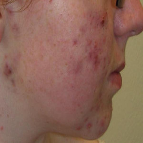 Acne Instance Segmentation Dataset by faceimage1