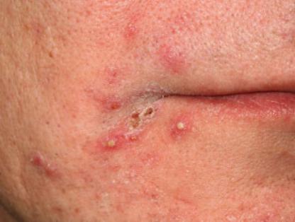 data_acne_train1 Object Detection Dataset by work