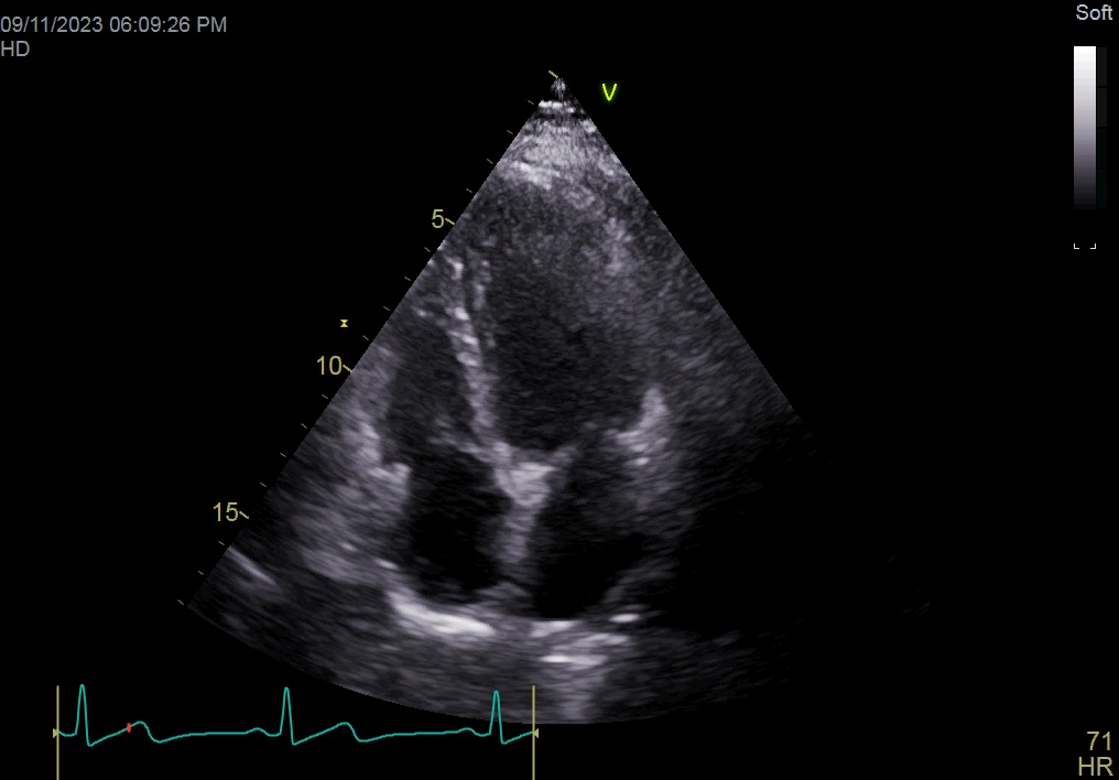 Heart_septum_new Object Detection Model by 4chamberheart