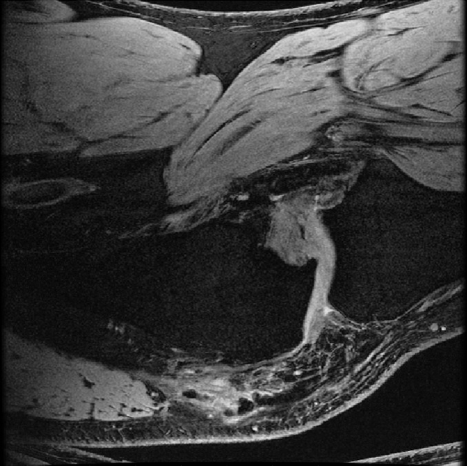 MRI Object Detection Dataset by shailesh