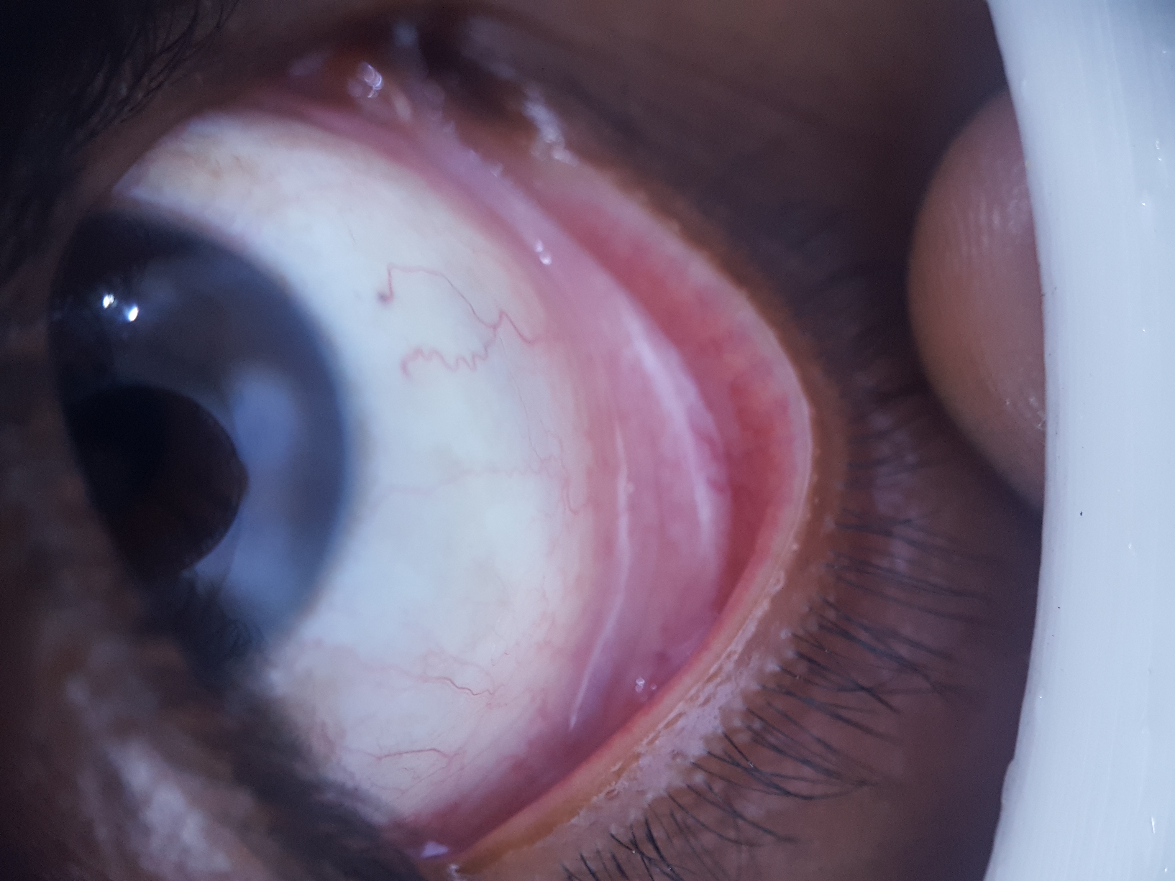 Anemia Detection V3 Classification Dataset V1 2024 11 14 9 58pm By Anemia
