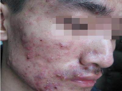 Acne Detection Object Detection Model by MagisterkaYOLO