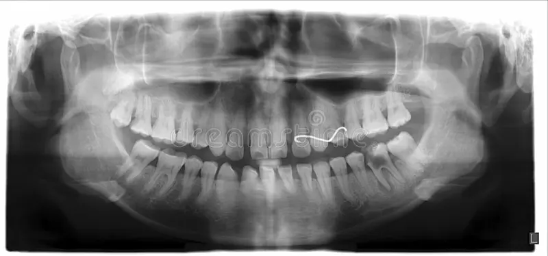 Caries Object Detection Dataset By Caries