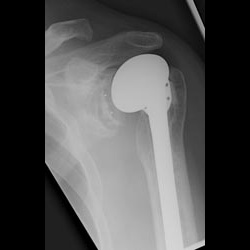 shoulder implant Object Detection Dataset and Pre-Trained Model by data